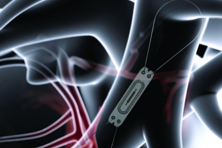 CardioMEMS Heart Failure (HF) System | Temple Health CardioMEMS Heart Failure (HF) System | Temple Health